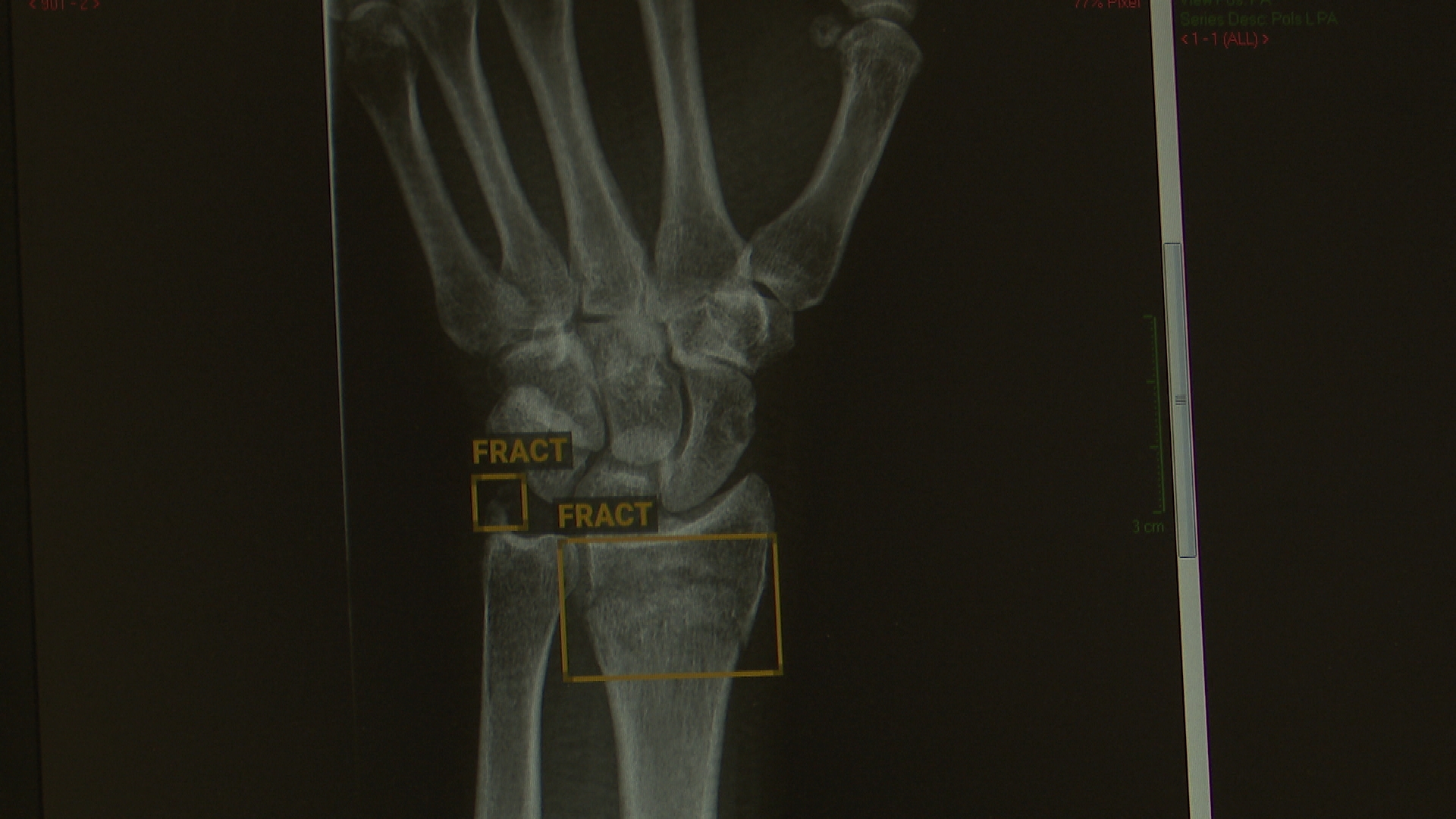 'Dokter' Gleamer weet binnen een paar minuten of je een botbreuk hebt ...