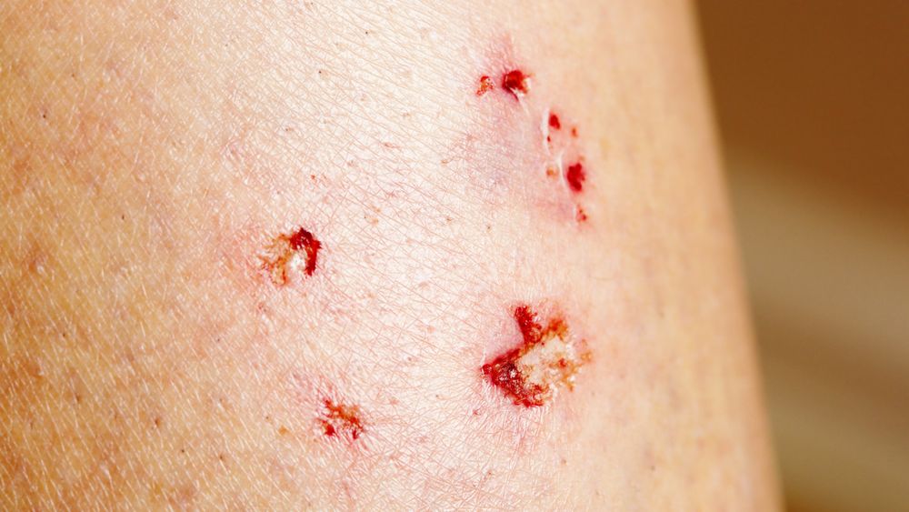 Wat te doen bij een bijtwond van mens of dier - L1