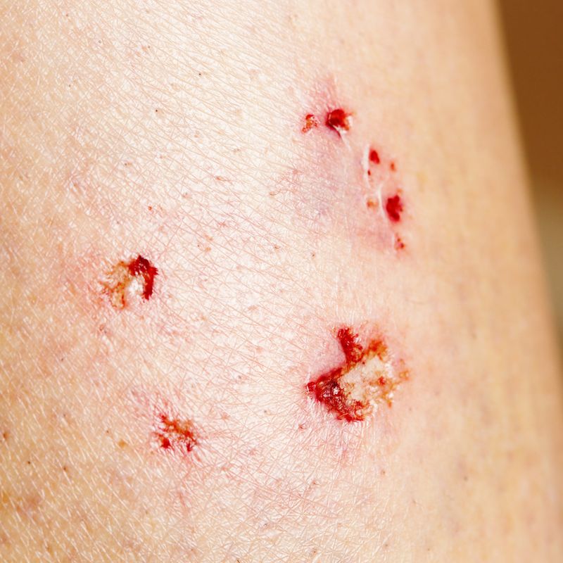 Wat te doen bij een bijtwond van mens of dier - L1